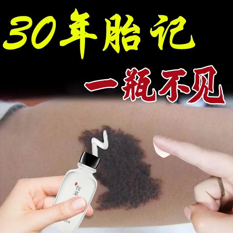 [TikTok with the same type of birthmark removal artifact permanent spot ...