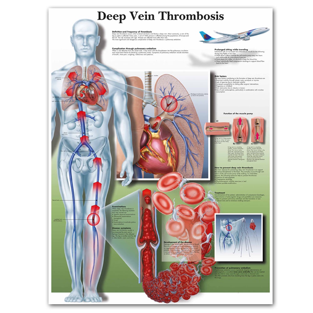 Poster and Print Deep Vein Thrombosis Chart Canvas Painting Wall ...