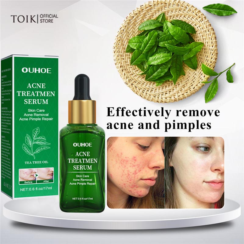Acne Removal Serum Anti-Acne Facial Essence Fade Acne Mark Oil Control ...
