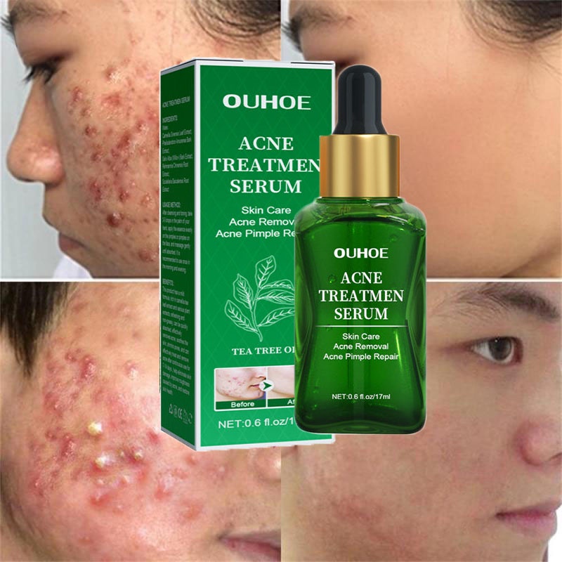 Acne Removal Serum Acne Scar Spots Pimple Treatment Shrink Pores Oil ...