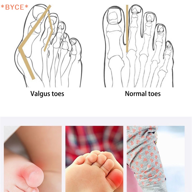 BYCE> Kids Hallux Valgus Corrector Bunions For Toes Corrector Foot ...