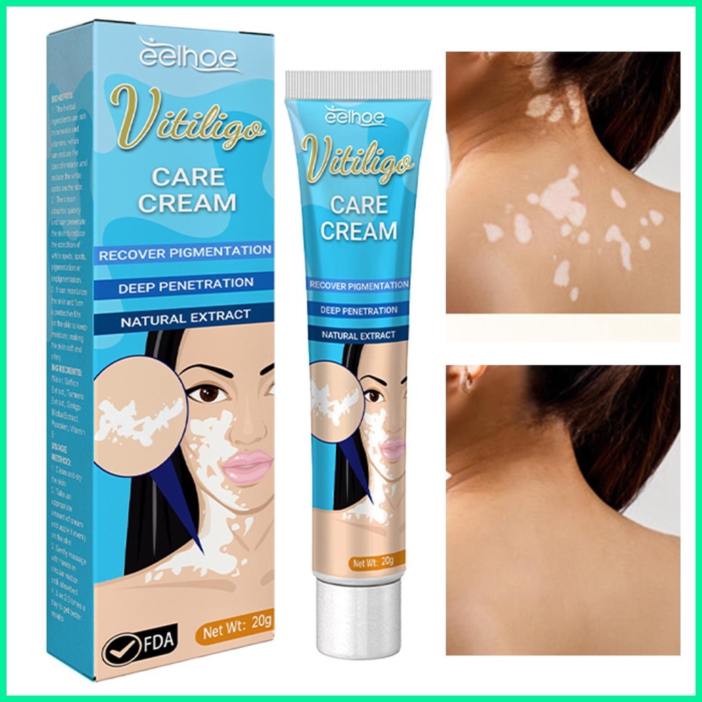 Vitiligo Care Cream 20g Vitiligo Relief Cream for White Spots on Skin ...