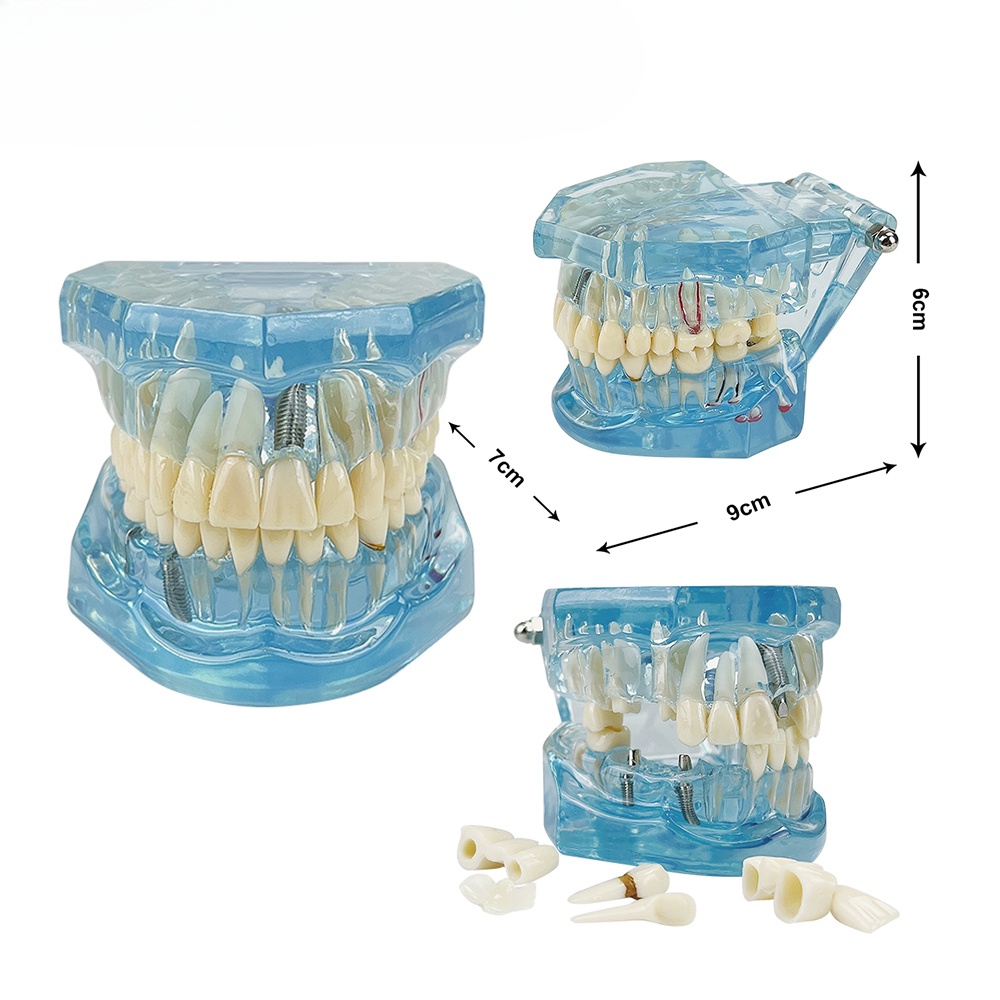 Dental Teeth Repair Model Disease Tooth Model for Dentist Student ...