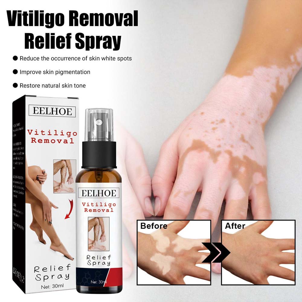 Eelhoe Vitiligo Removal Relief Spray Repair White Spot Desalination ...