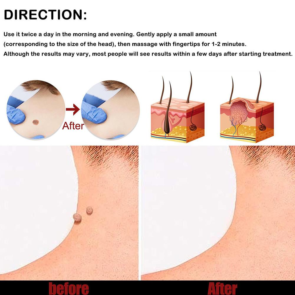 Mole Removal Wart Remover Cream Herbal Formula Clear Skin Dark Spot ...