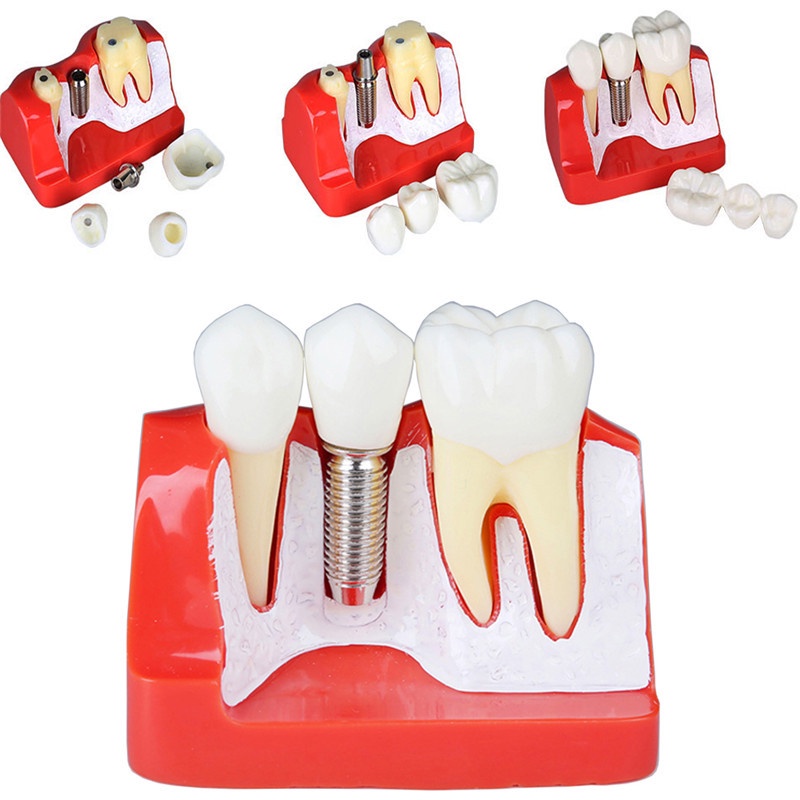 4 Times Dental Implant Disease Model Analysis With Restoration Crown ...