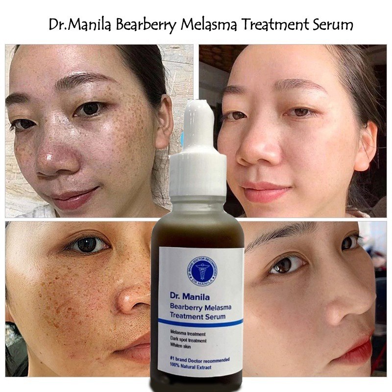 DR Manila Bearberry Melasma Treatment Serum ( No.1 Treatment For ...