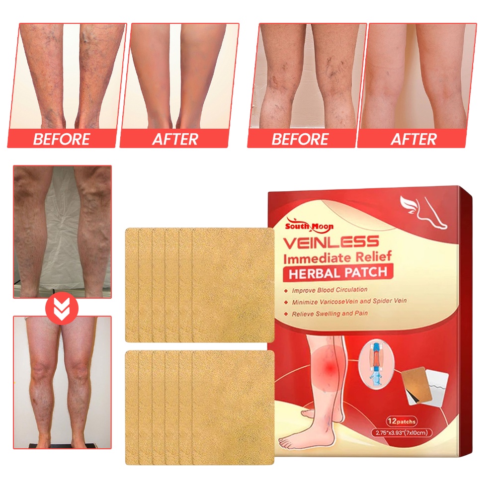 Veins Patch Black Cream Medicine Patch 12 Patches Varicose Veins Patch ...