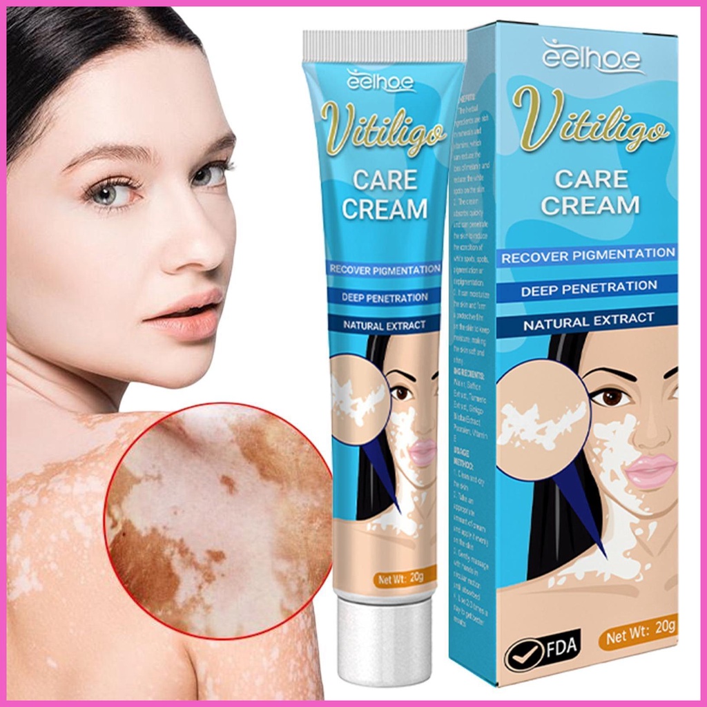 Vitiligo Care Cream 20g Vitiligo Relief Cream for White Spots on Skin ...