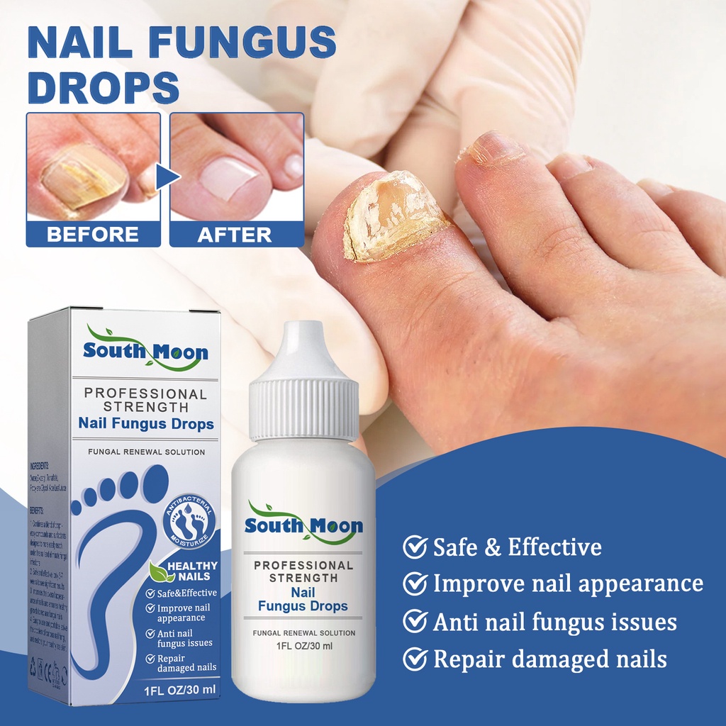 Anti Fungal Drops Anti Infection Paronychia Onychomycosis Hand Foot ...