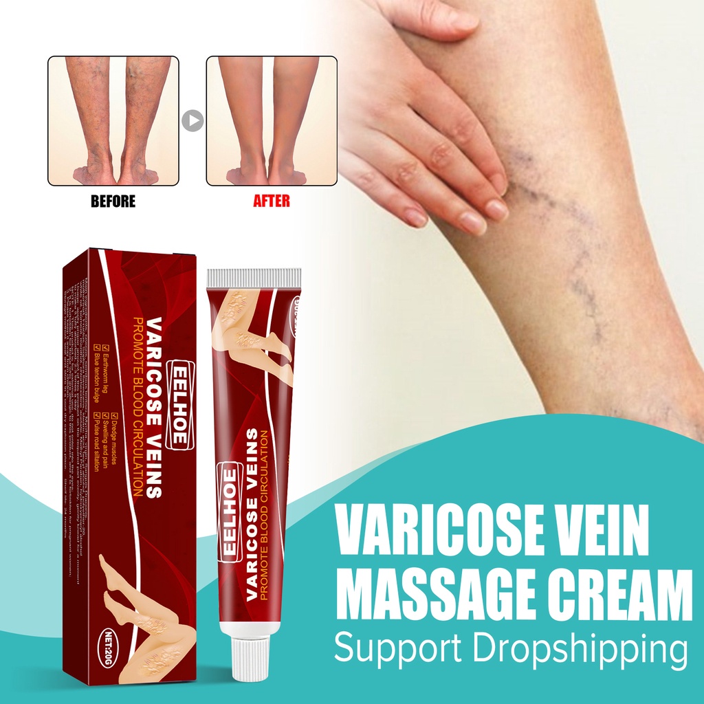 Varicose Veins Cream Relieve Leg Vascular Bulge Pain Earthworm Leg ...