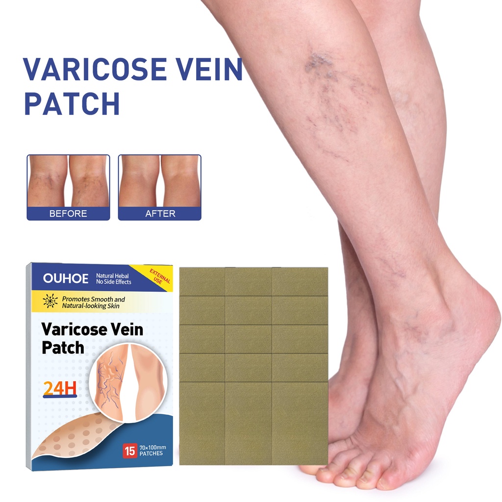 15pcs Leg Varicose Veins Patch Leg Vasculitis Phlebitis Spider Anti ...