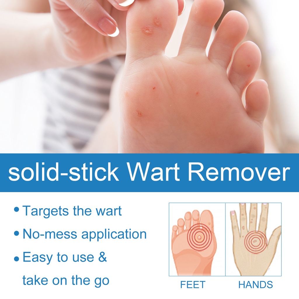 Foot Corns Treatment Cream Stick Remove Skin Tag Papillomas Dark Spots ...