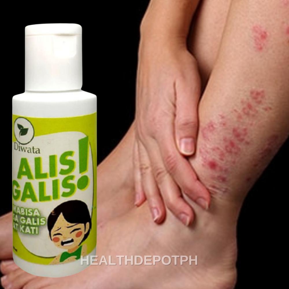BUY 1 GET 1 Alis Galis Itching Solution Skin Itchiness Skin Rashes ...