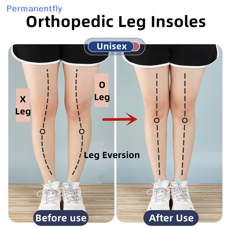 Permanentfly Silicone Orthopedic Insoles for Feet O/X Leg Type Valgus ...