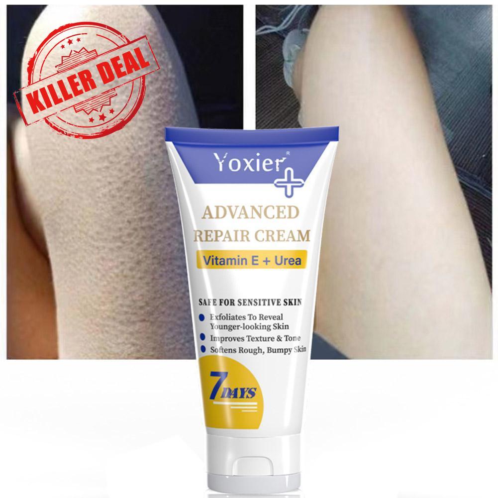 50g Curing Keratosis Pilar Repair Cream Remove Chicken Beauty Skin ...