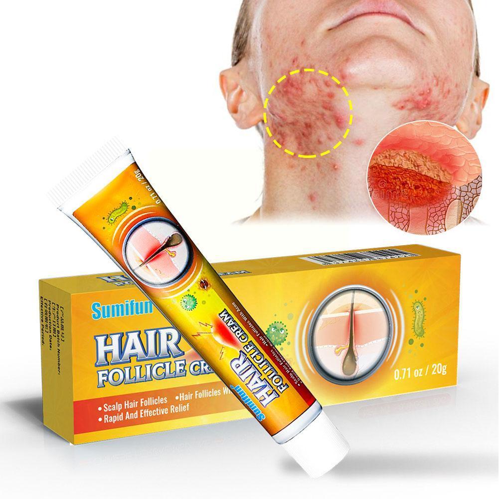 Folliculitis Cream Scalp Hair Folliculitis Medicine Spot Treatment ...