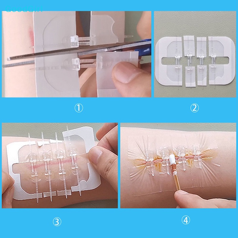 GoodGirl 10 Buckles Zipper Band-aid Suture-free Wound Dressing Patches ...
