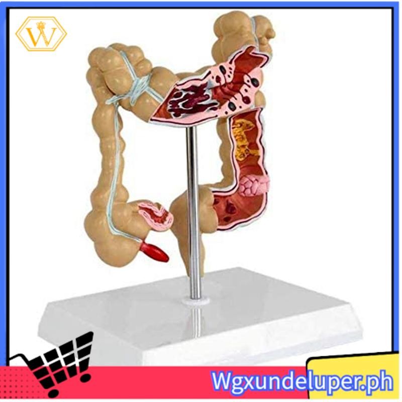 【W】Colon Pathological Colorectal Cancer Model Large Intestine Model ...
