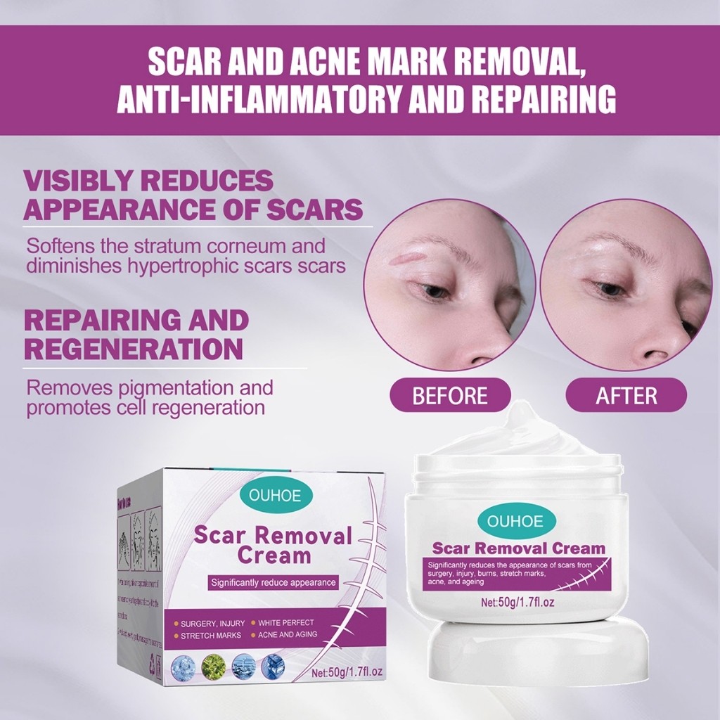 Scar Removal Cream Old Scar Remover Cream Effective Peklat Acne ...