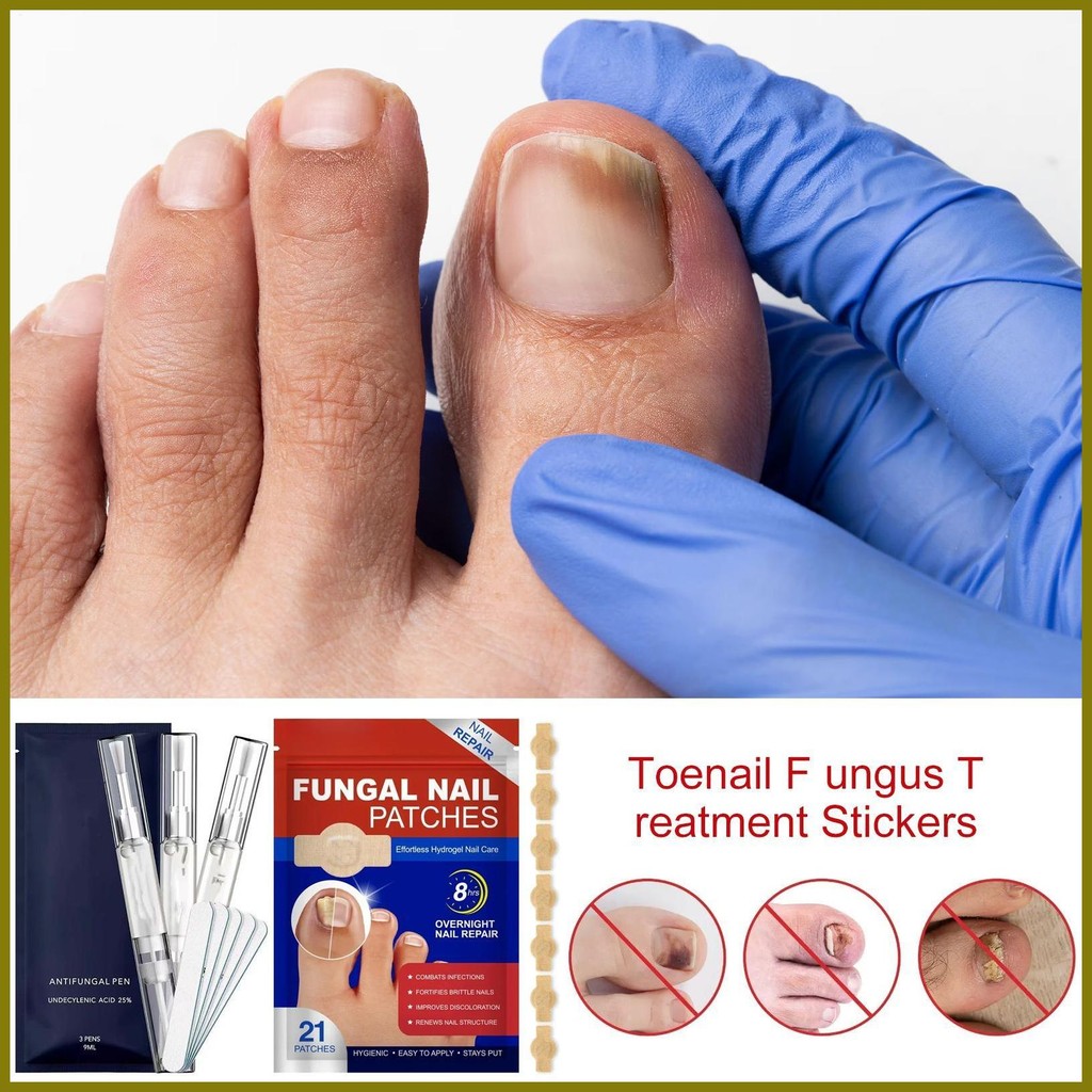 Toenail Pen Damaged Nails Patch Fast Acting Strength Renewal Pen Patch ...