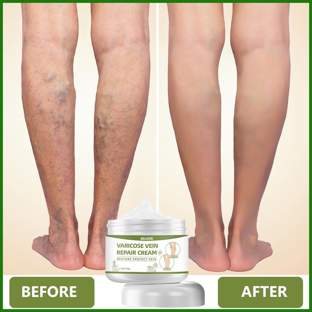 Varicose Veins Cream Vein Care Fading CreamRelief Phlebitis Angiitis ...