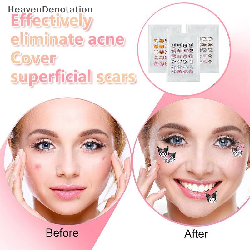 HCC 20/24Pcs Acne Pimple Patch Sticker Acne Pimple Remover Tool Blemish ...