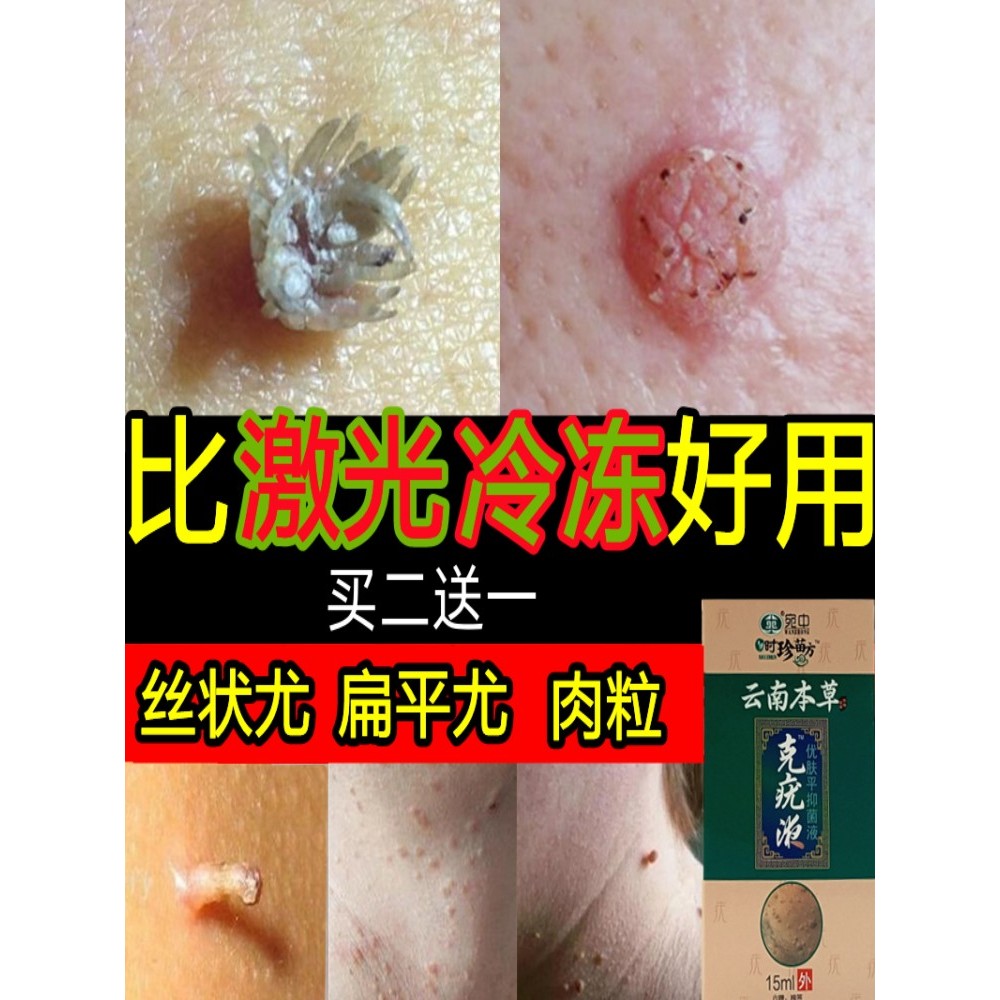 Plantar Wart Special Plaster for Removing Warts, Root, and Fleshy Spurs ...