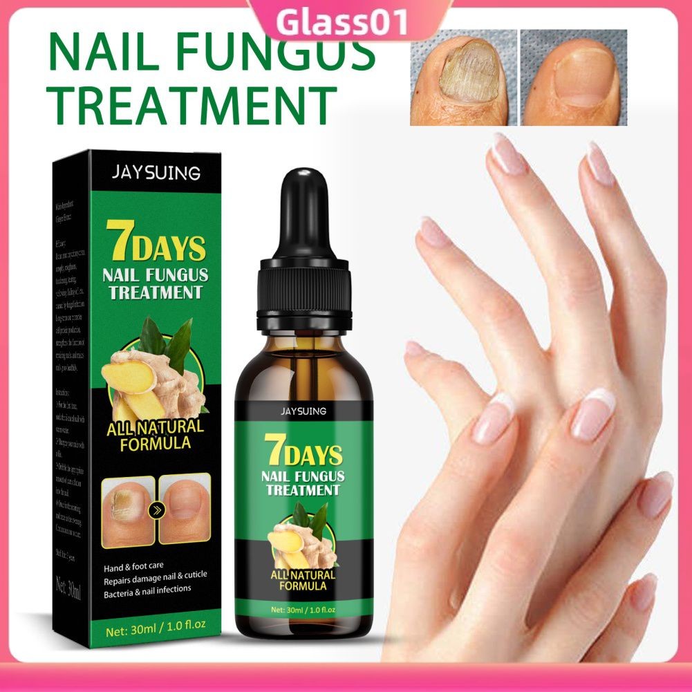 Jaysuing Ginger Nail Care 7 Days Fungal Treatment Feet Care Essence ...