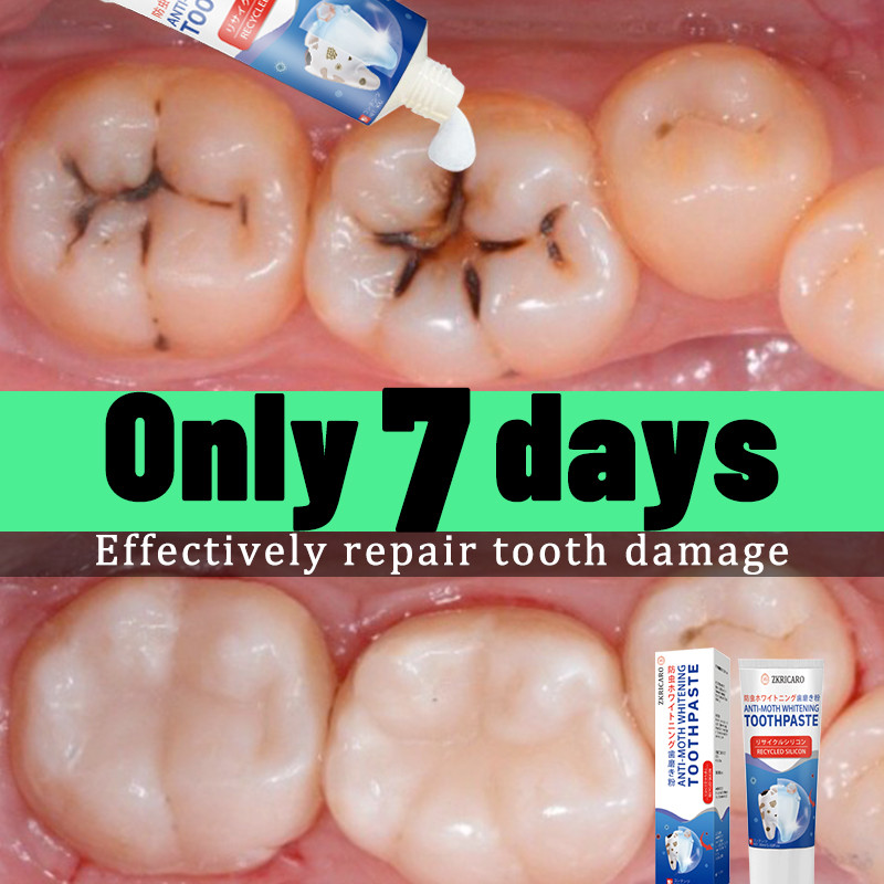 【Best Sale】Toothpaste for Cavities Fluoride restorative toothpaste ...