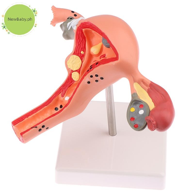 NewBaby 1Pcs Medical Props Model Pathological Uterus Ovary Anatomical ...