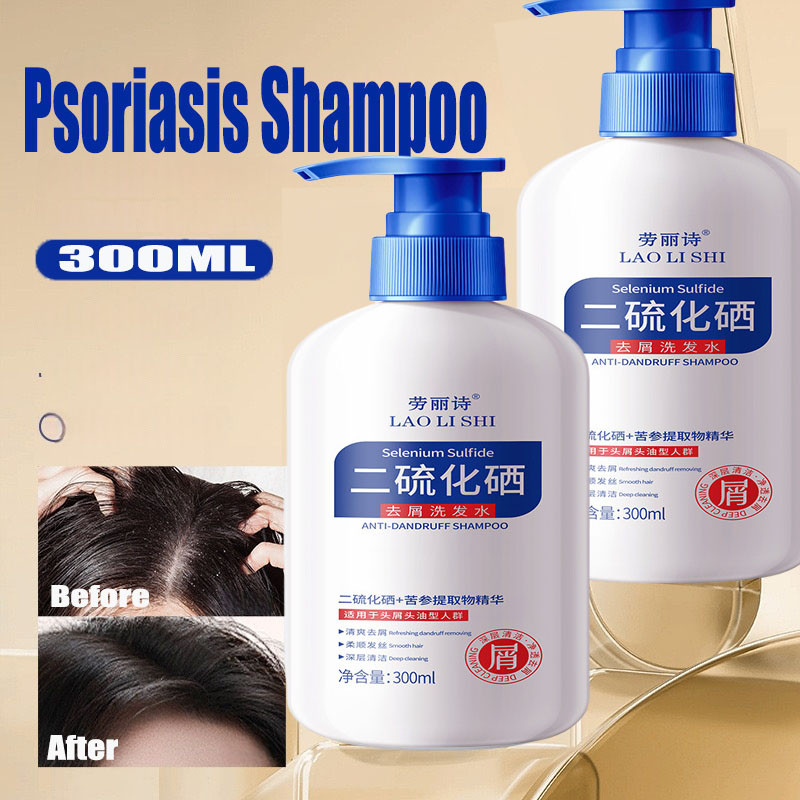 Psoriasis Shampoo 300ML Hair Care Smooth Scalp Treatment Dandruff ...