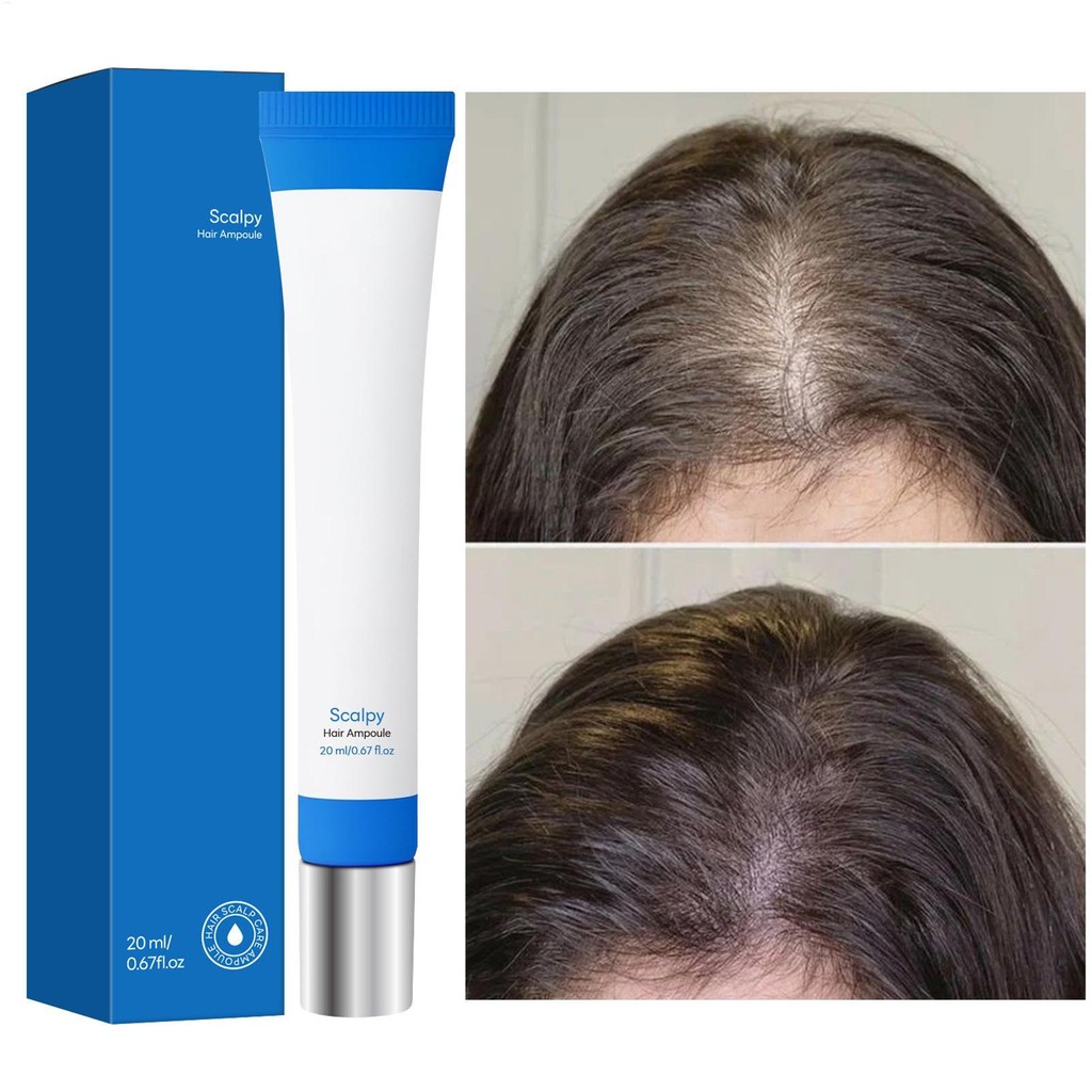 Scalp Growth Essence, Anti-hair Loss Cream, Anti-dandruff, Relieve ...