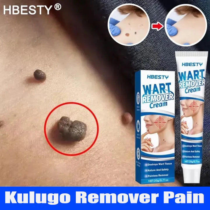 Warts Remover Cream Kulugo Skin Tags Moles Remover Warts Treatment 20g ...
