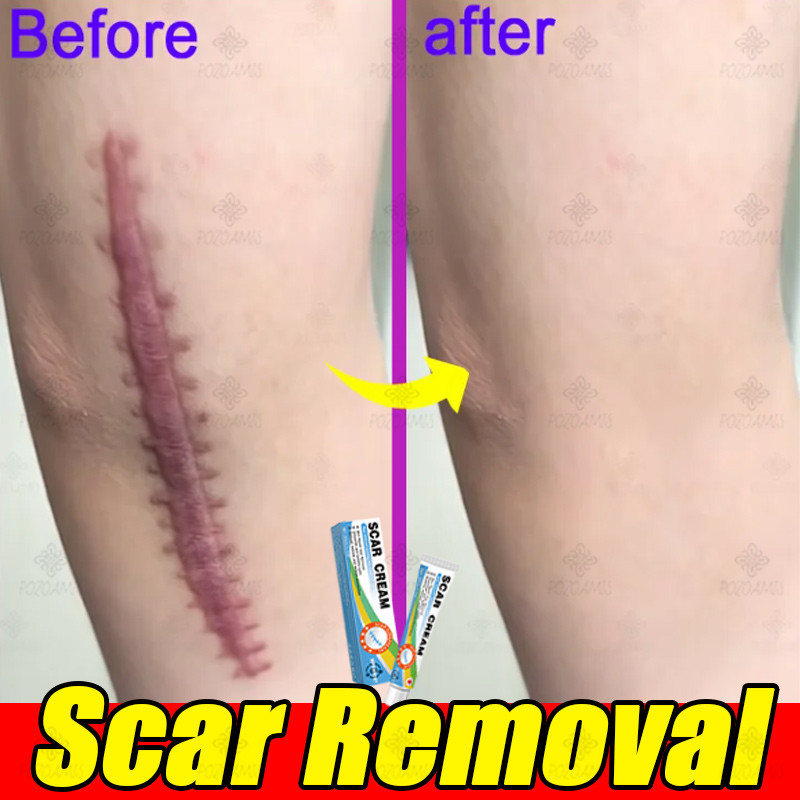 Scar removal cream, burn scars, wound marks, acne scars and stretch ...