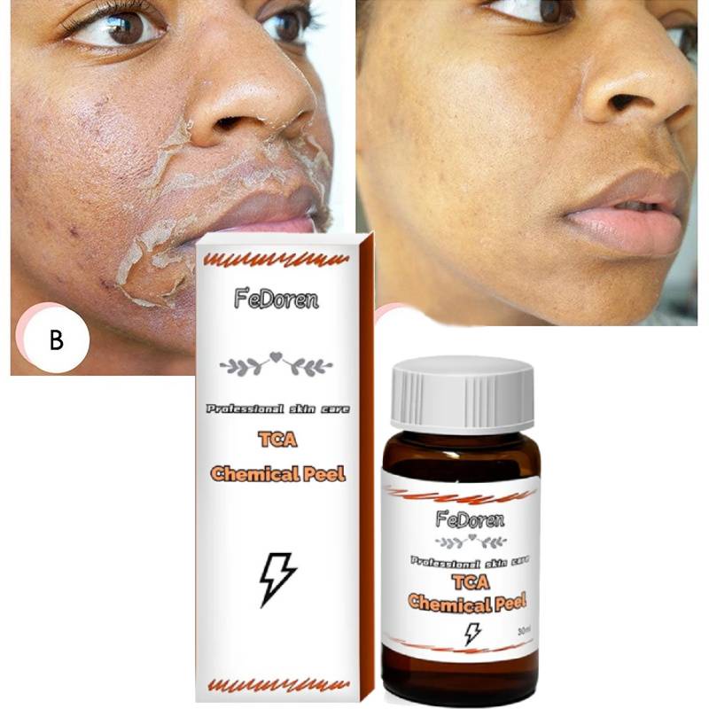 TCA PEELING SOLUTION 30% 50% 70% 30ML / Safe for Skin/ Removes melasma ...