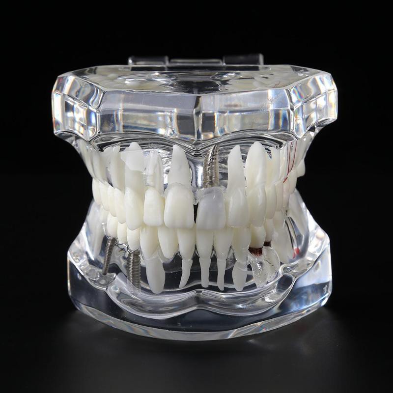 Disease Teeth Model With Restoration Bridge Tooth Dentist For Medical ...