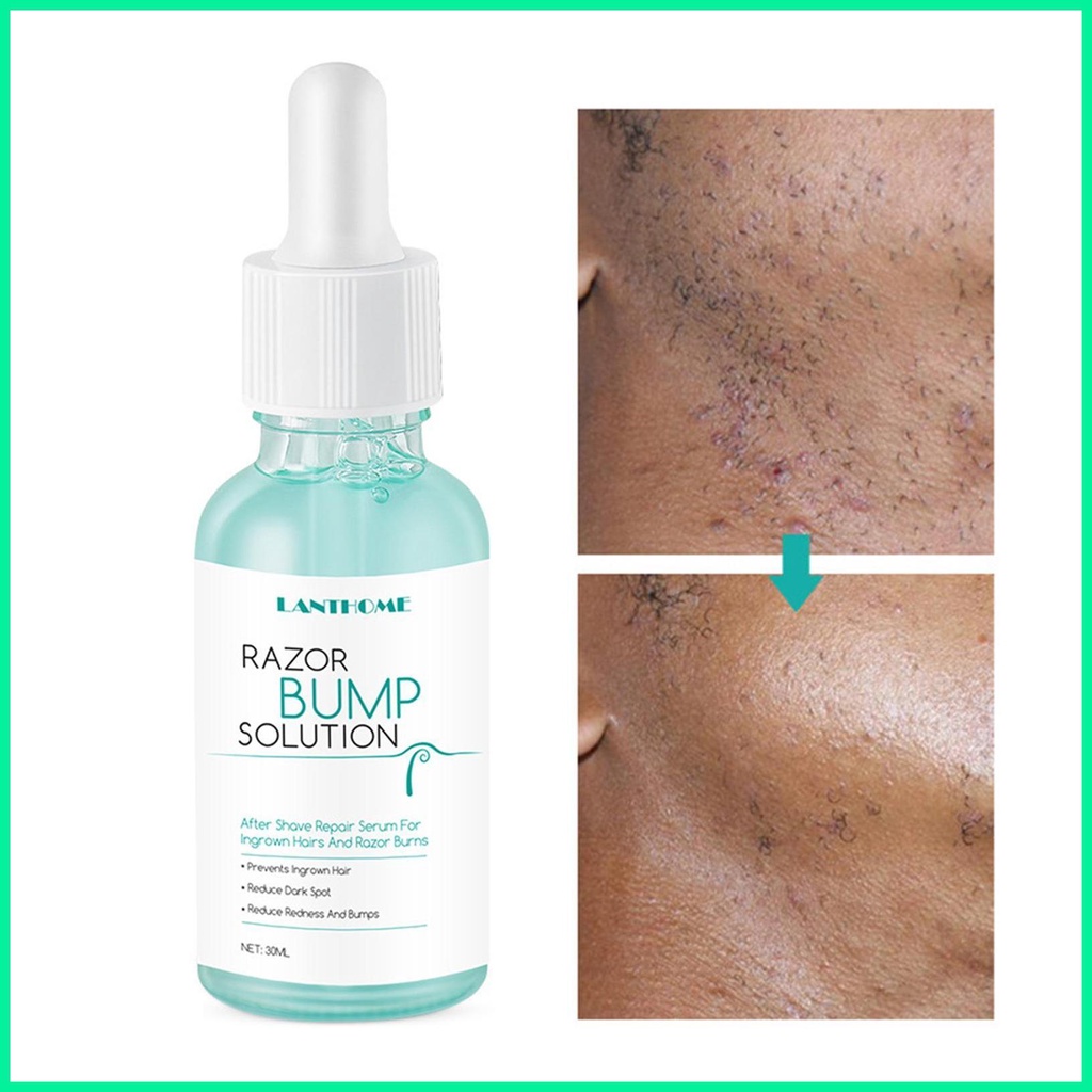 Razor Bumps Essence 30ml Ingrown Hair and Razor Bump Treatments After ...