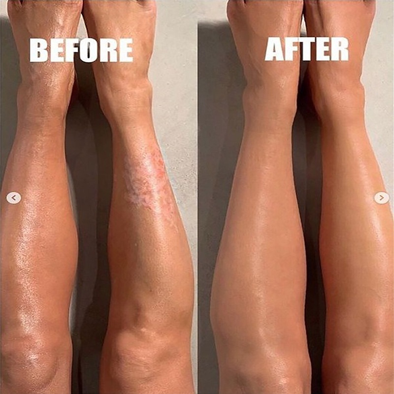 Psoriasis Antibacterial Cream Dermatitis Eczematoid Ointment Effective ...