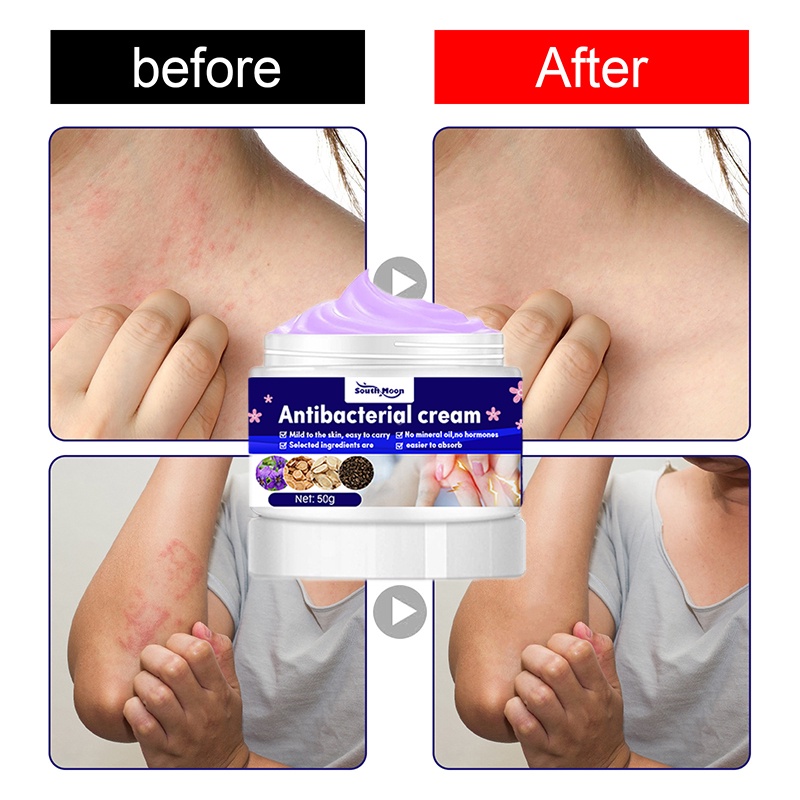 Psoriasis Antibacterial Cream Dermatitis Eczematoid Ointment Effective ...