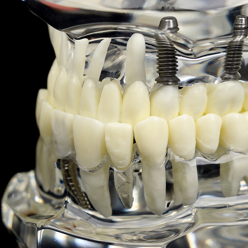 Implant Dental Disease Teeth Model With Restoration Bridge Tooth ...