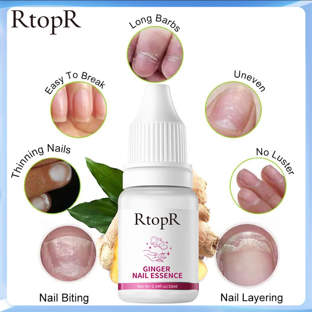 Rtopr Ginger Antibacterial Nail Treatment Onychomycosis Paronychia Anti ...