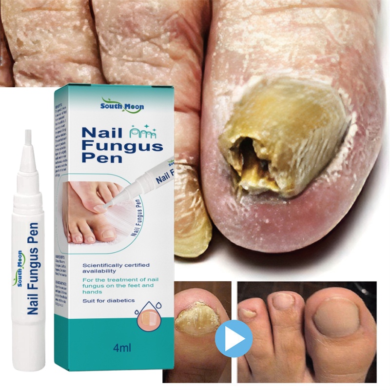 Paronychia Treatment Liquid Pen Nail Fungus Repair Pain Anti Infection ...