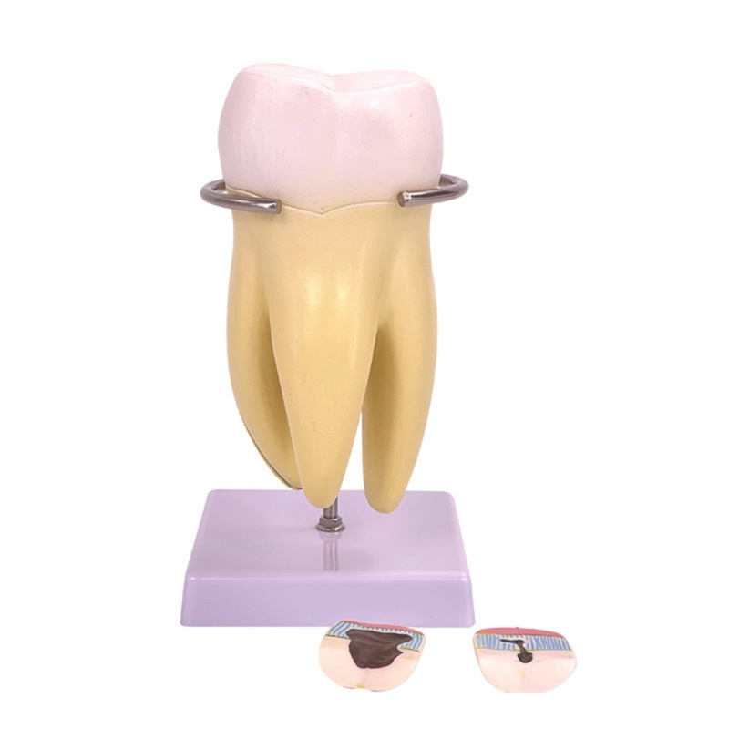 love* Dental Anatomy Model Molar Teeth Model for Dental Diseases Study ...