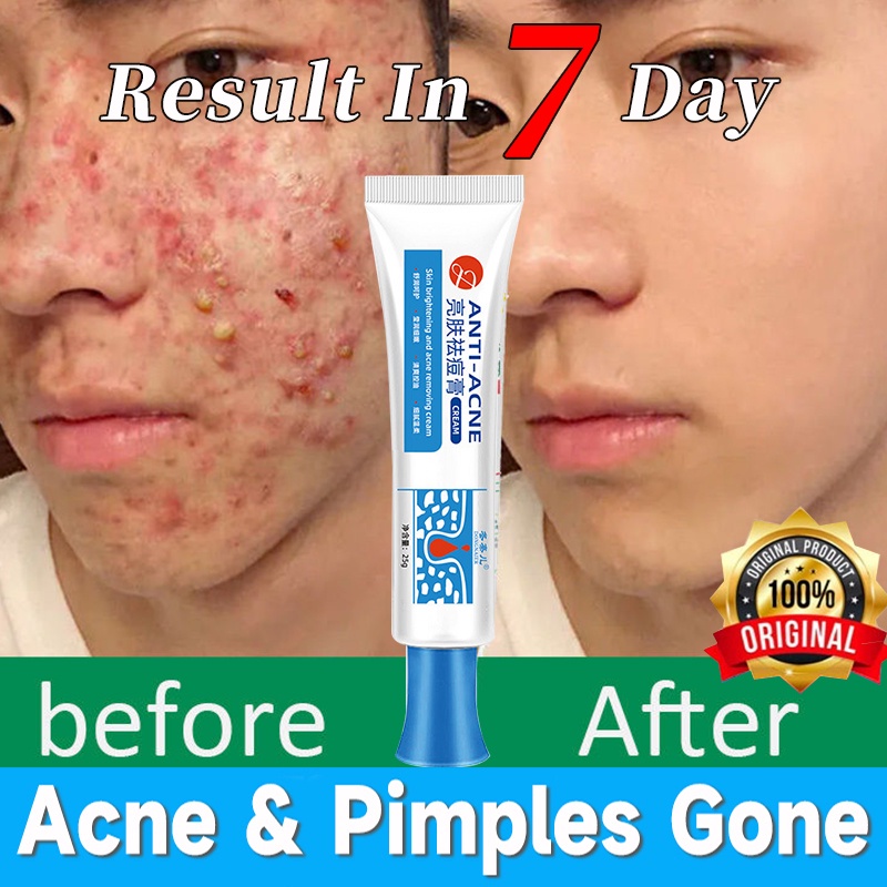 Skin Brightening Acne Cream Facial Repair Fading Acne Scars Acne Treatment Acne Anti-Acne Gel ...