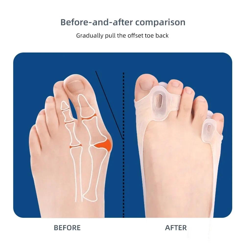 1pair Silicone Toe Separator Fingers Feet Toe Spreader Hallux Valgus ...