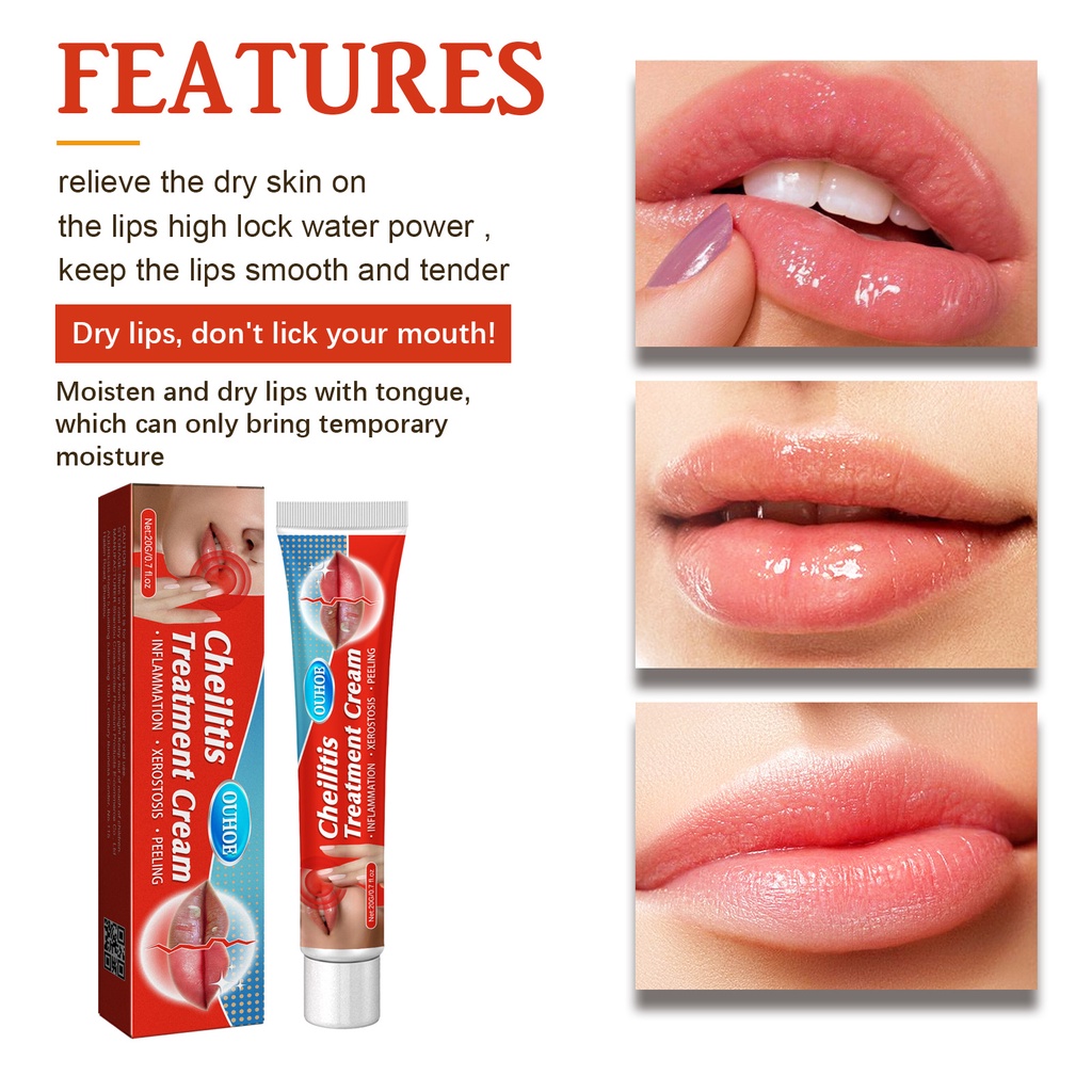 OUHOE Cheilitis Treatment Cream Lip Repair Cream 20g Repairs Dry Flaky ...