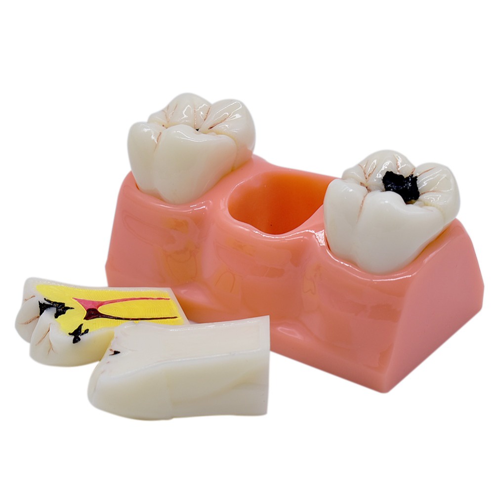 Four Times Dental Caries Model Caries Evolution Model Dental Model ...