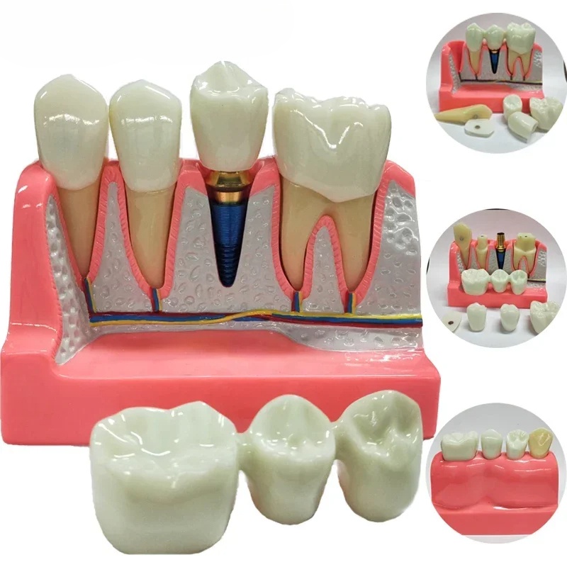 Dental Teach Crown Bridge Removable Model Porcelain Teeth Model Dental ...