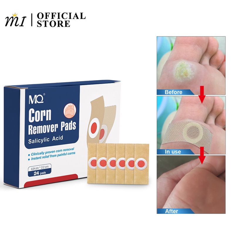 24PCS Warts remover Foot Corns Remover Patch To remove calluses on the ...
